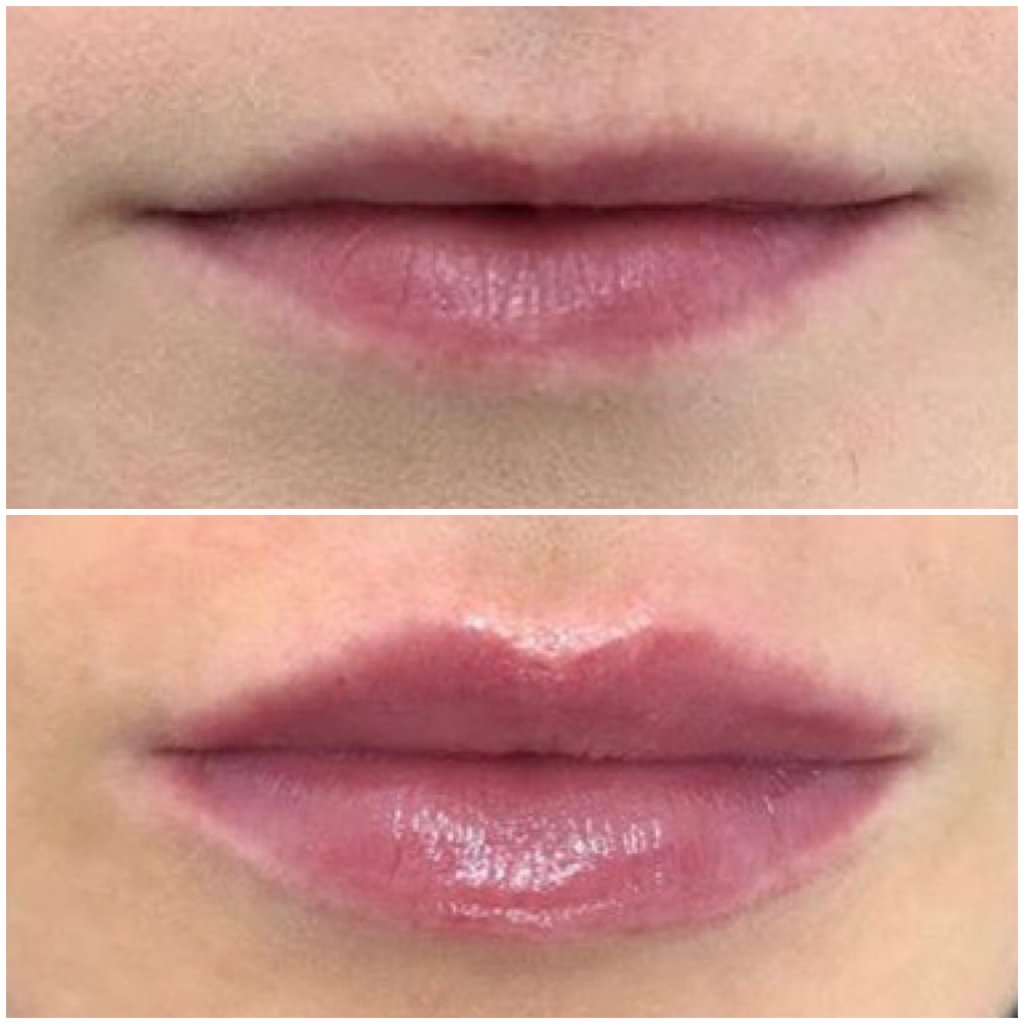 I've Got Small Lips But Im Worried About Getting Lip Fillers - L1P